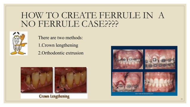 Ferrule effect | PPSX | Dental Health | Diseases and Conditions