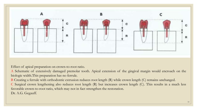 Ferrule effect | PPSX | Dental Health | Diseases and Conditions