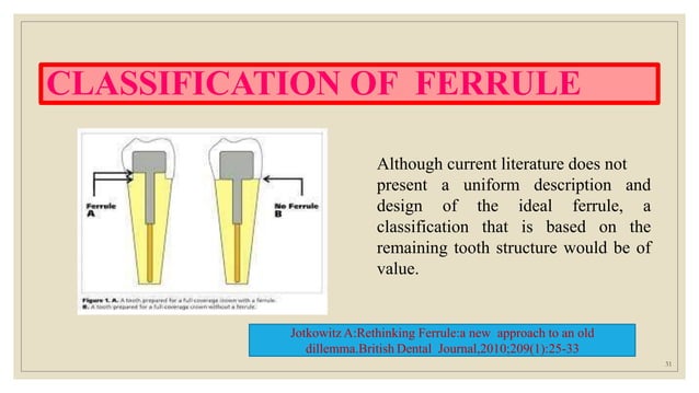 Ferrule effect | PPSX | Dental Health | Diseases and Conditions
