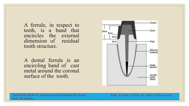Ferrule effect | PPSX | Dental Health | Diseases and Conditions