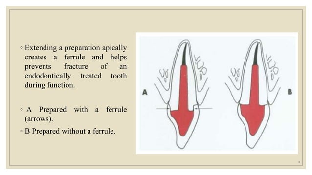 Ferrule effect | PPSX | Dental Health | Diseases and Conditions
