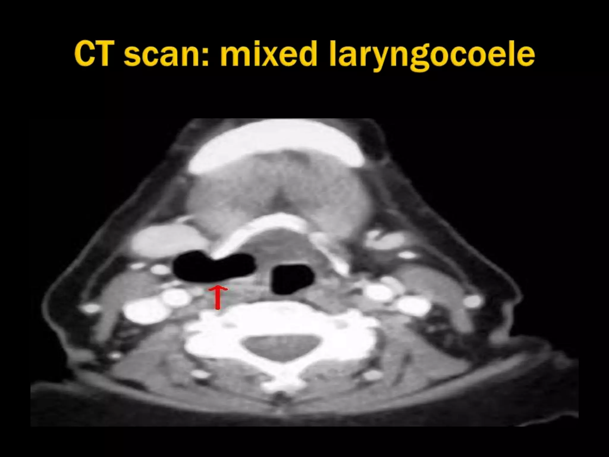 14. benign lesions of larynx kk | PPT | Ear, Nose and Throat Conditions ...