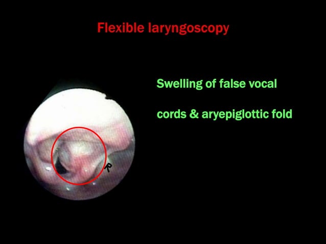 14. benign lesions of larynx kk | PPT | Ear, Nose and Throat Conditions ...