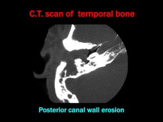 14. chronic suppurative otitis media attico antral disease | PPT