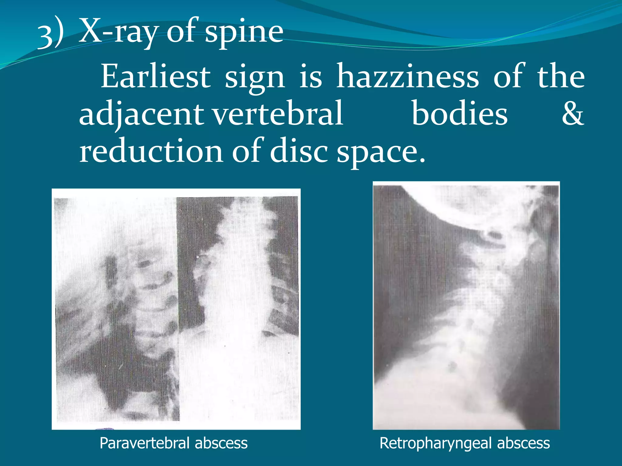 Tuberculosis spine | PPT