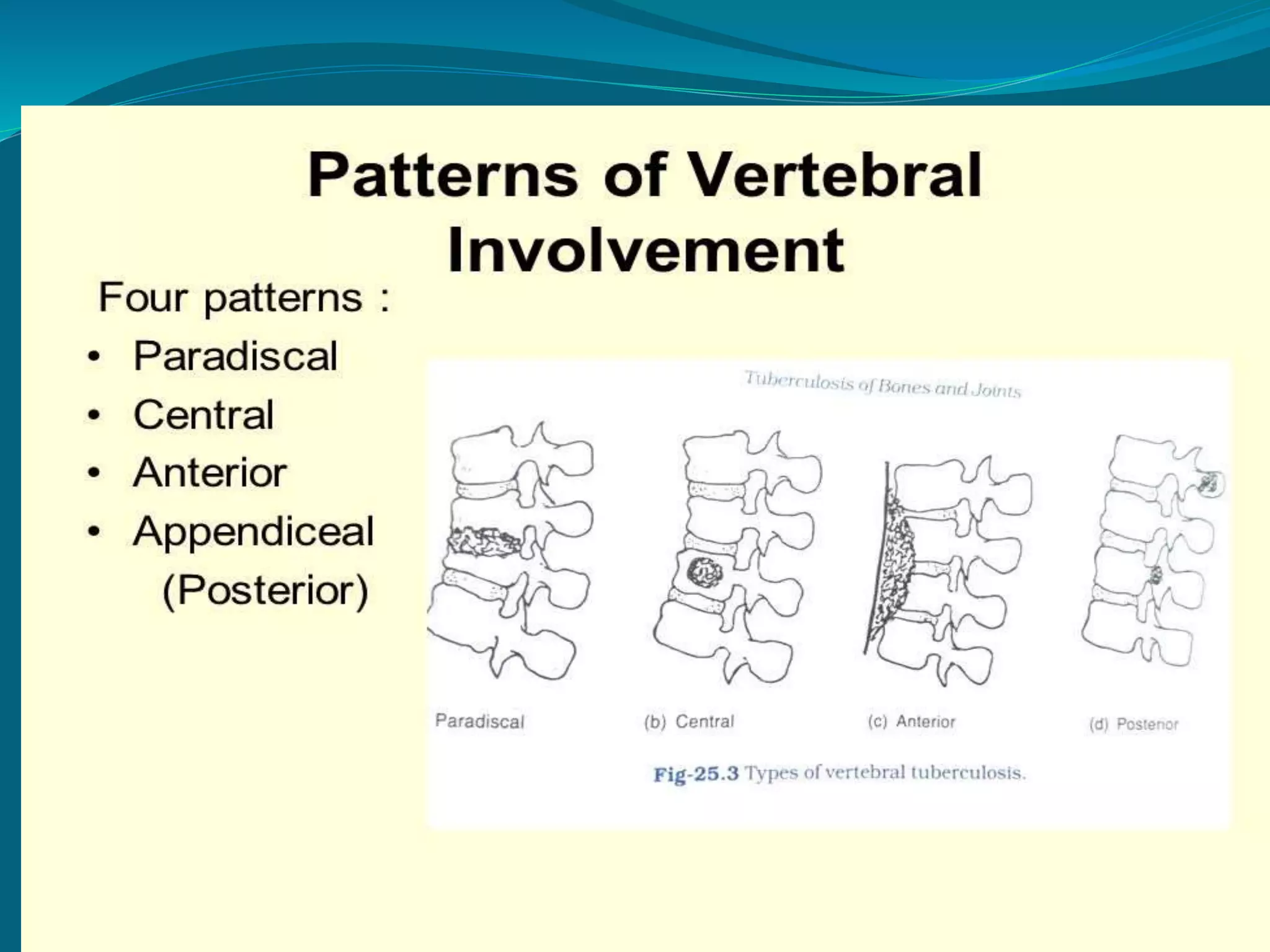 Tuberculosis spine | PPT