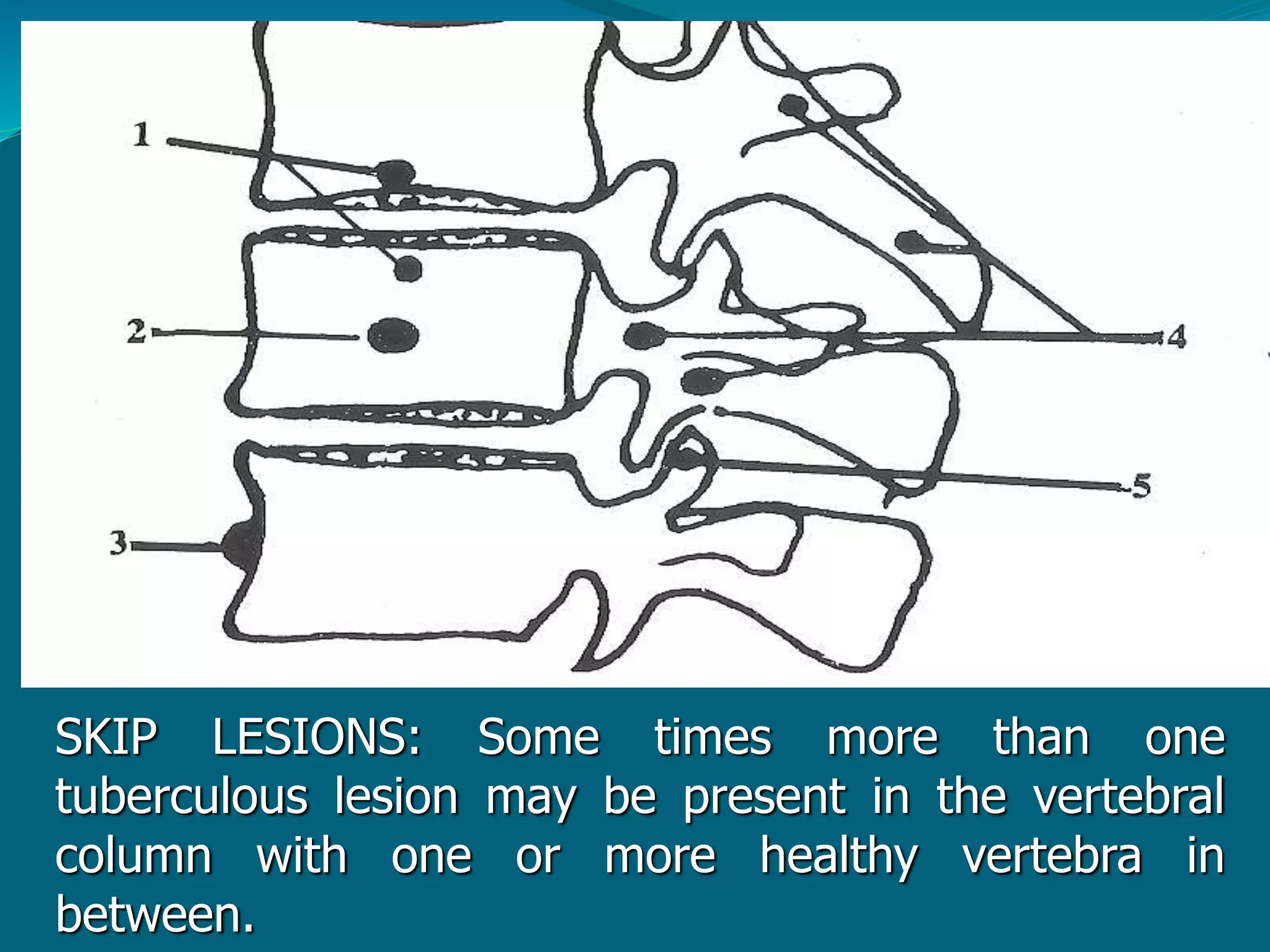 Tuberculosis spine | PPT