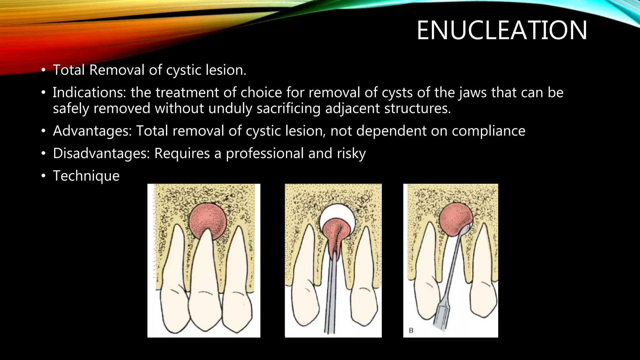 Management of Cysts | PPTX