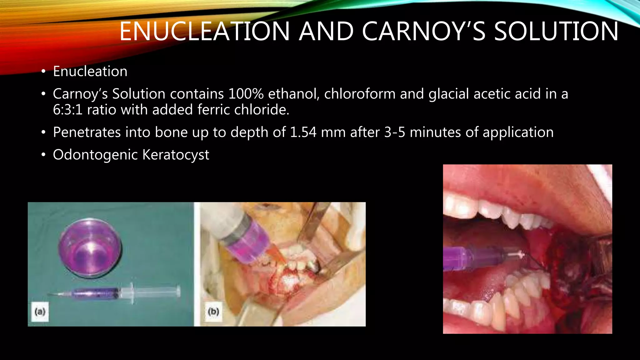 Management of Cysts | PPTX