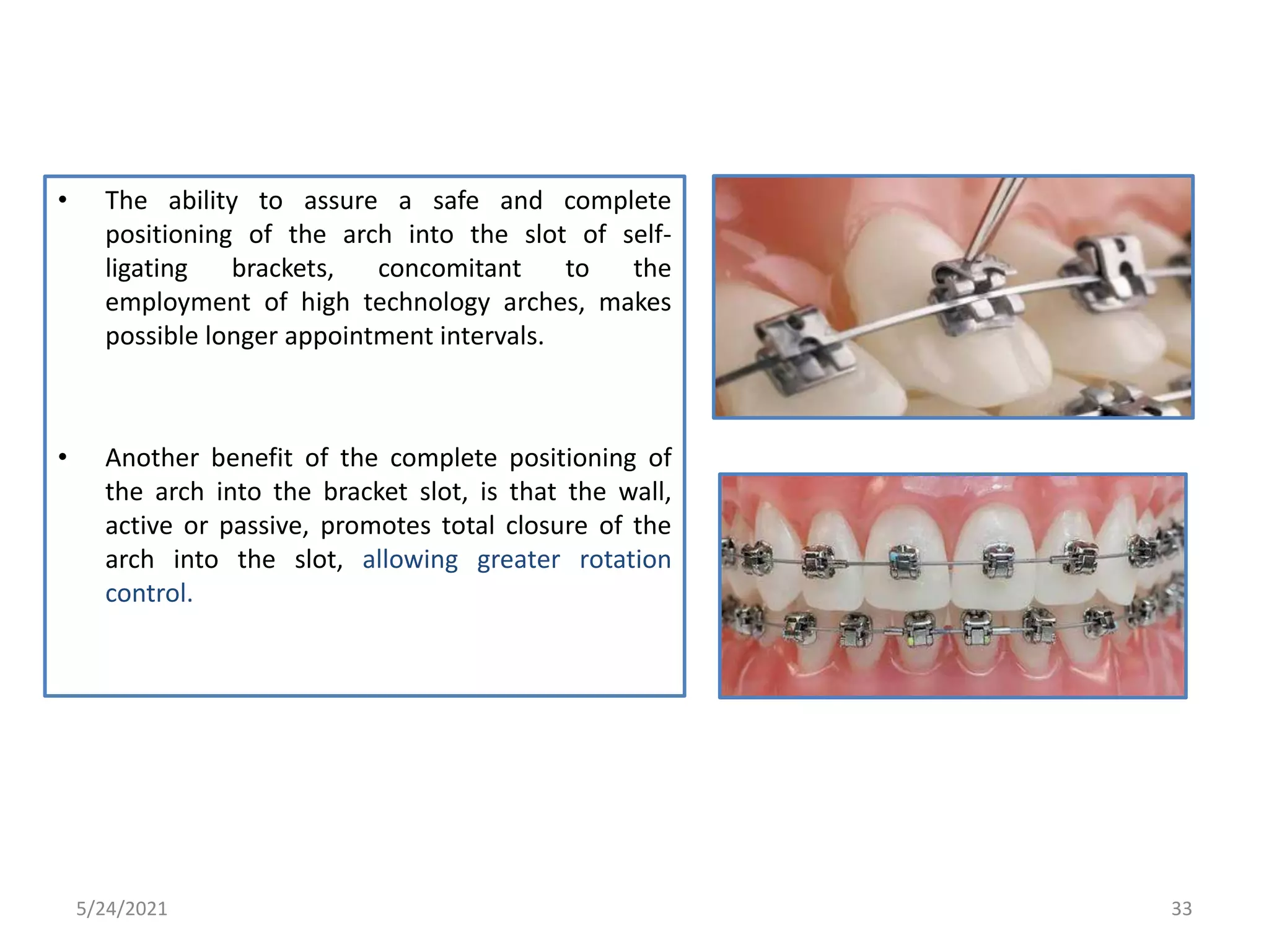 SELF LIGATING BACKETS | PPTX