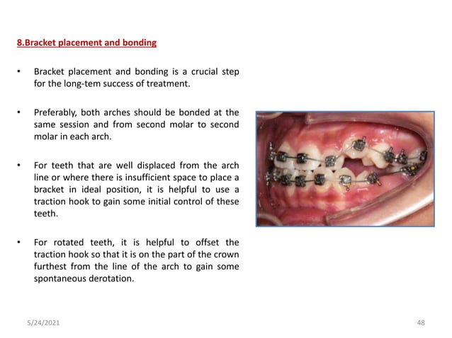 SELF LIGATING BACKETS | PPTX | Dental Health | Diseases and Conditions