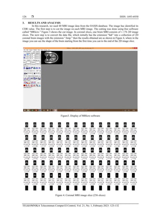 Hippocampus’s volume calculation on coronal slice’s for strengthening the diagnosis of Alzheimer ...