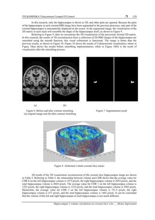 Hippocampus’s volume calculation on coronal slice’s for strengthening the diagnosis of Alzheimer ...