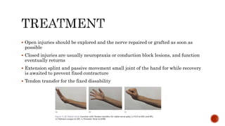 14. Radial Nerve Injury.pptx | Death, Injury, or Military Conflict ...