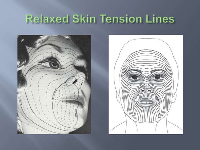Scar Revision in oral and Maxillofacial Surgery | PPT