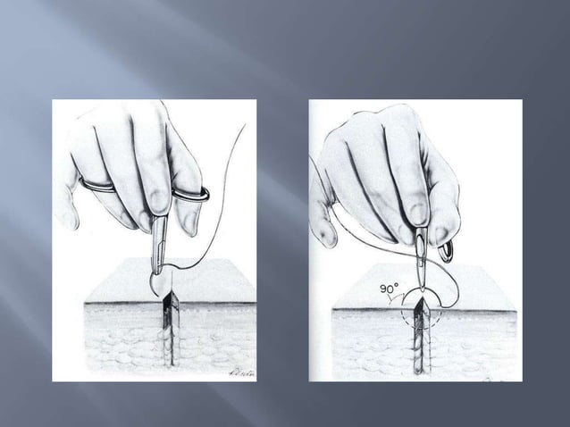 Scar Revision in oral and Maxillofacial Surgery | PPT