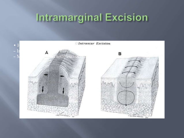 Scar Revision in oral and Maxillofacial Surgery | PPT