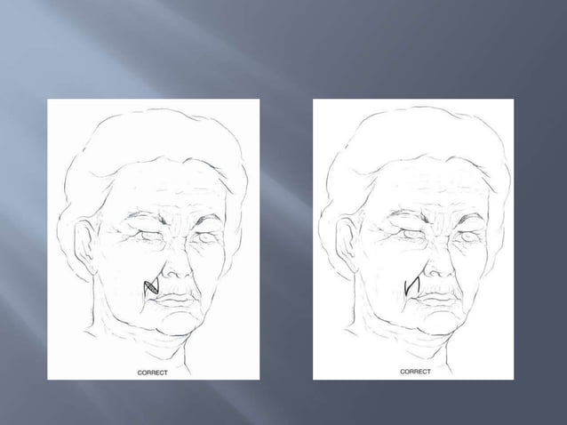 Scar Revision in oral and Maxillofacial Surgery | PPT