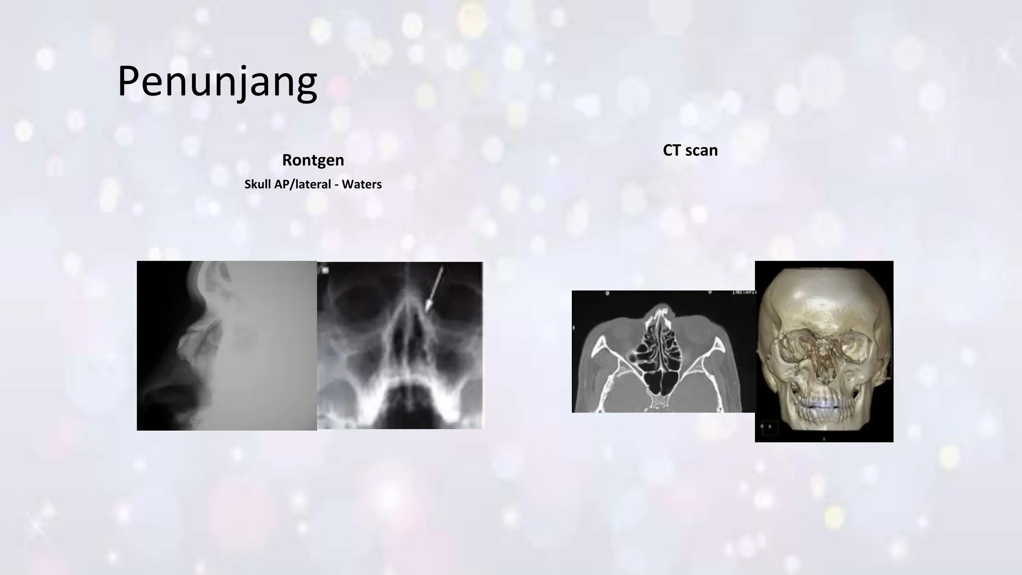Kuliah Kedokteran Trauma tulang wajah powerpoint | PPTX