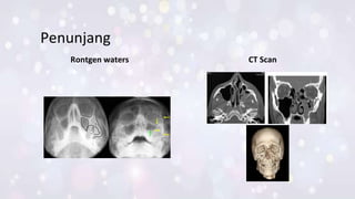 Kuliah Kedokteran Trauma tulang wajah powerpoint | PPTX