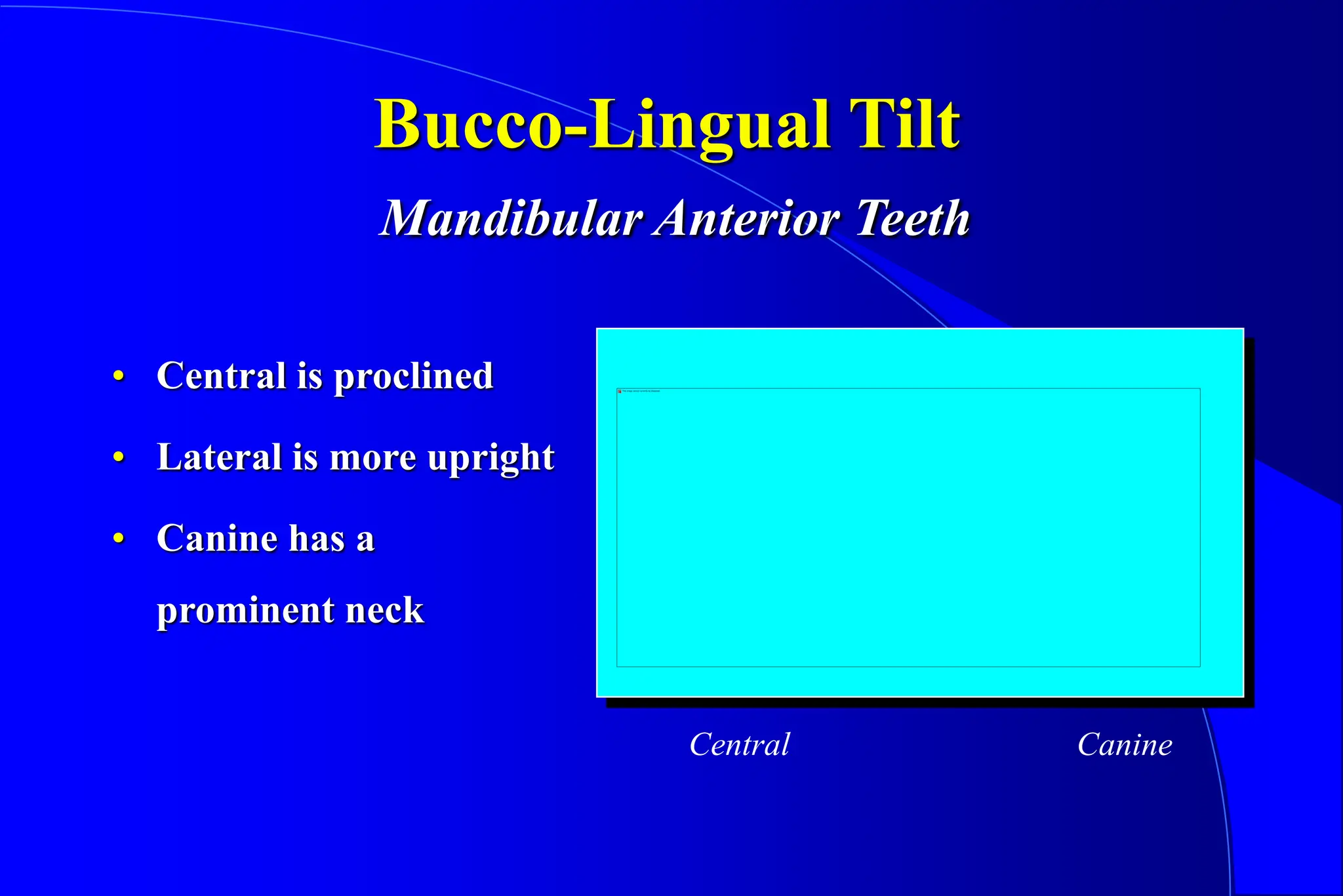 Setting Maxillary Anterior Teeth for aesthetics and phonetics.ppt