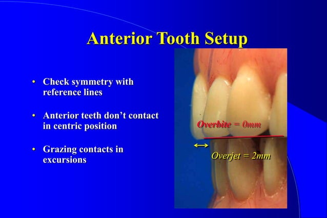 Setting Maxillary Anterior Teeth for aesthetics and phonetics.ppt ...