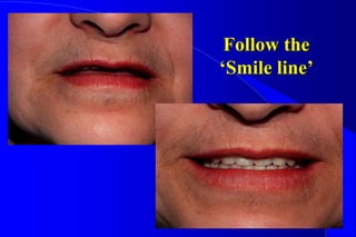 Setting Maxillary Anterior Teeth for aesthetics and phonetics.ppt