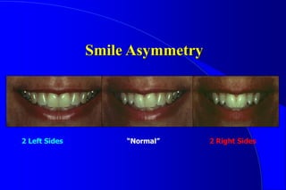 Setting Maxillary Anterior Teeth for aesthetics and phonetics.ppt
