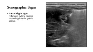 14. Hypertrophic Pyloric Stenosis. pptx | PPT