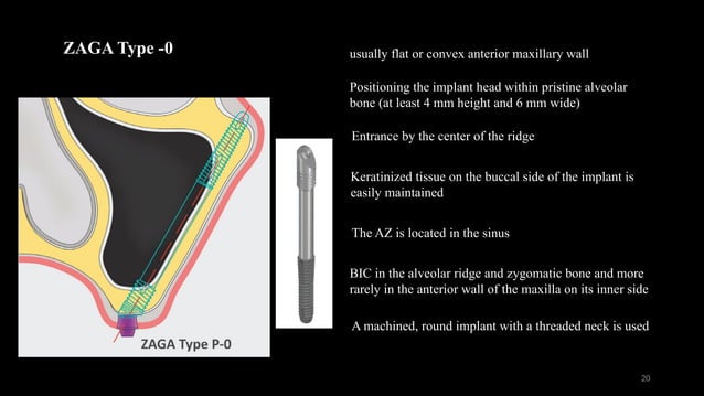 ZAGA (Zygoma Anatomy Guided Approach) Technique | PPTX
