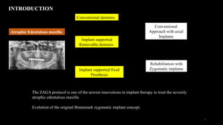 ZAGA (Zygoma Anatomy Guided Approach) Technique | PPTX