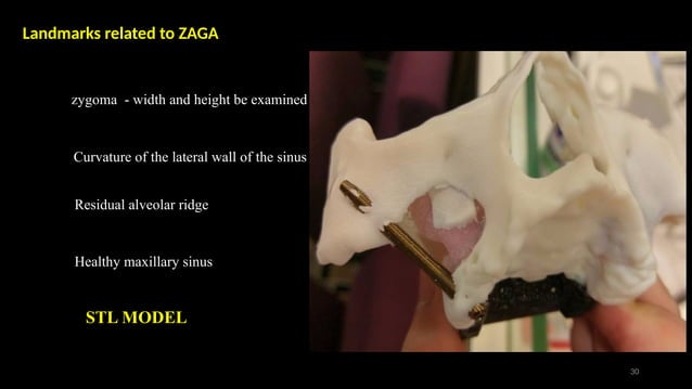 ZAGA (Zygoma Anatomy Guided Approach) Technique | PPTX