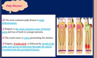 14. Pulp and Periapical Diseases. .pdf