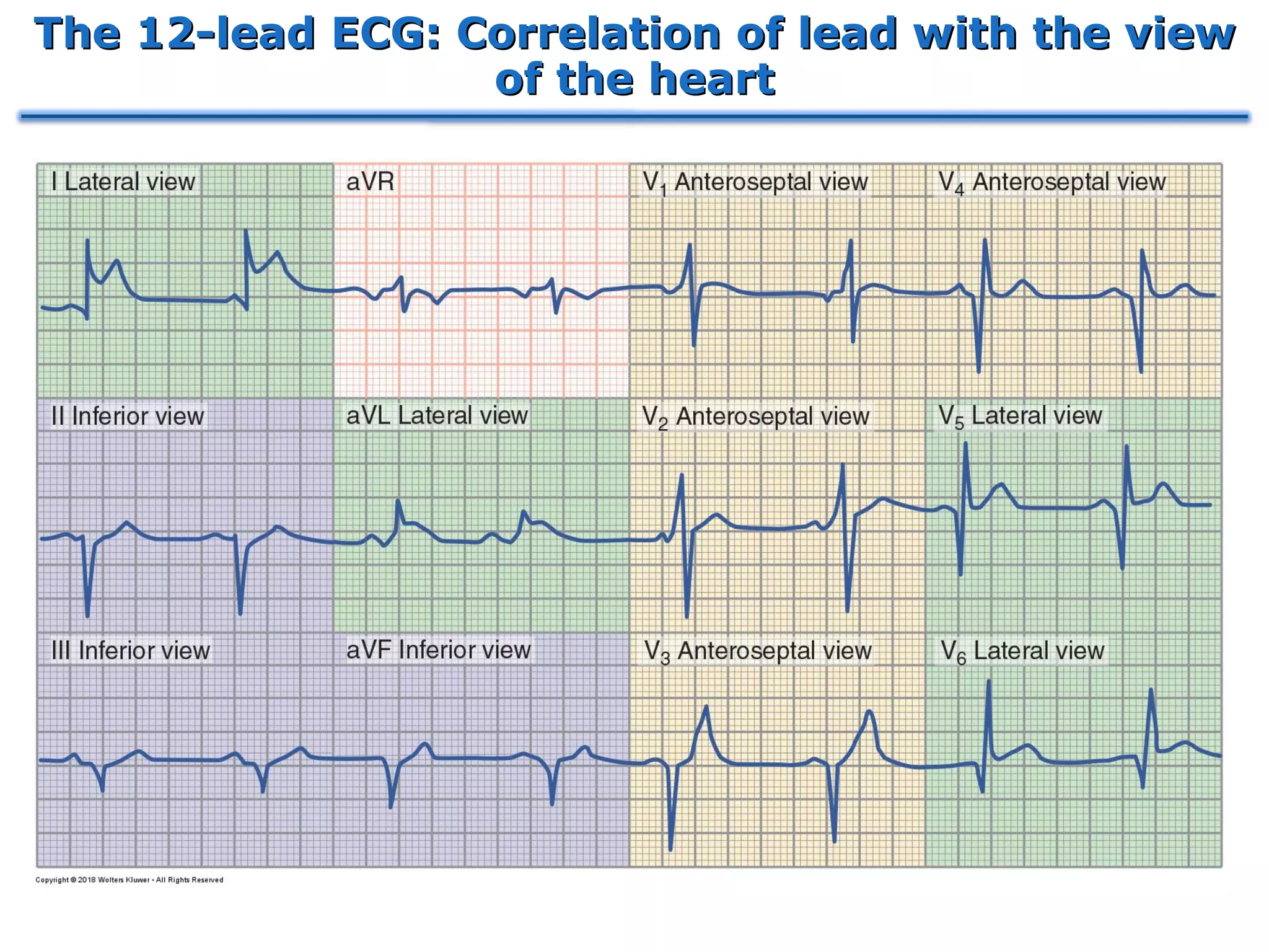 14- Acute Myocardial Infarction.pdf