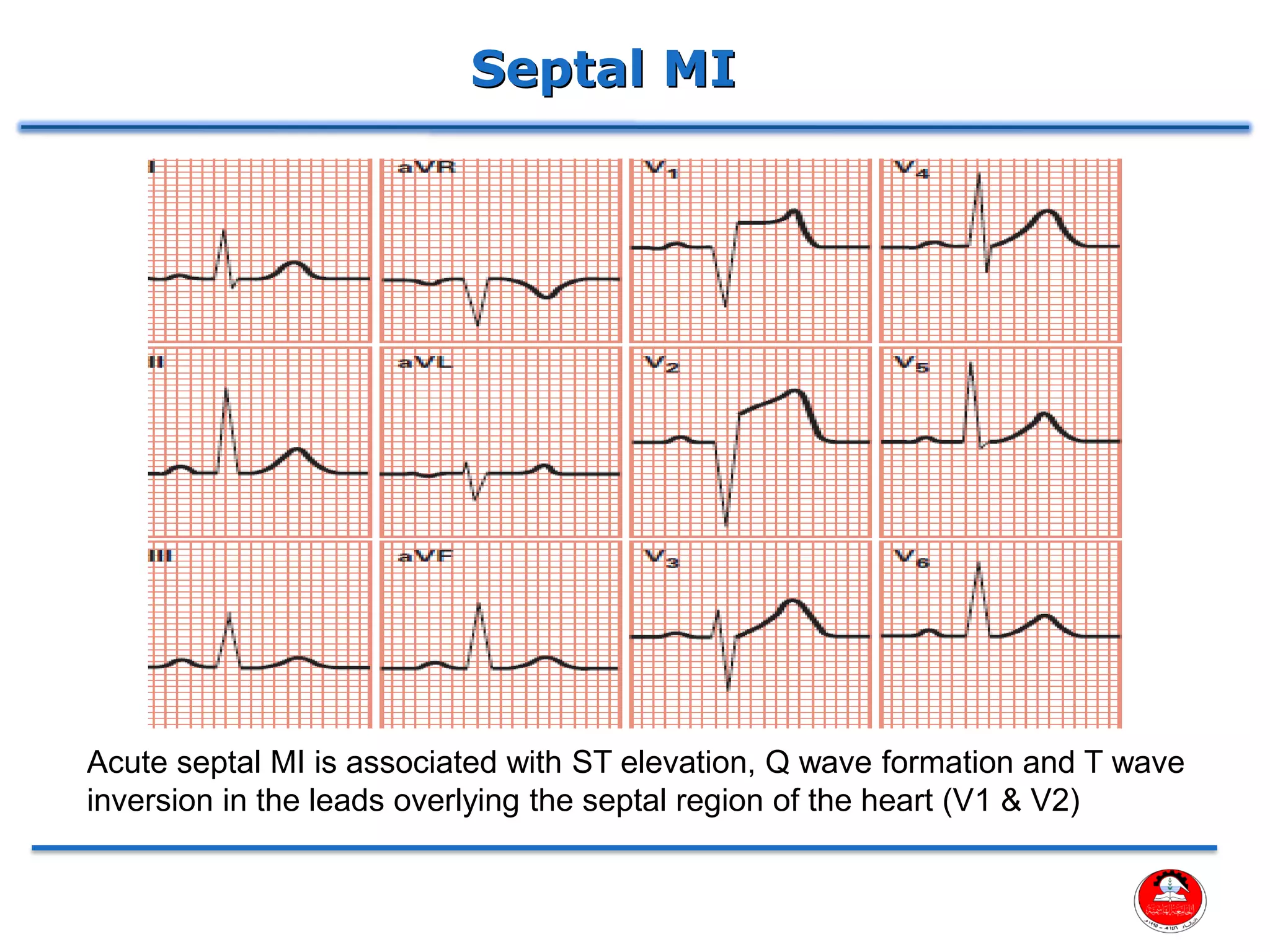14- Acute Myocardial Infarction.pdf