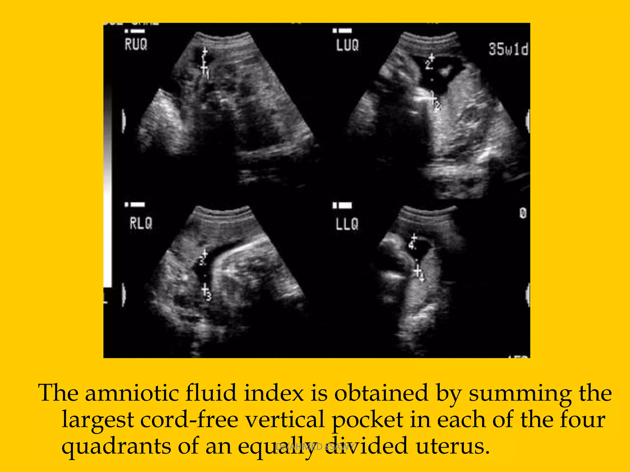14-amniotic fluid imaging Dr Ahmed Esawy | PDF
