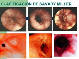 14. enfermedad de reflujo gastroesofagico 2004 | PPT