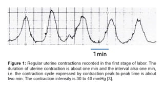 14 monitoring of labor progress 23-4-2018 | PPTX