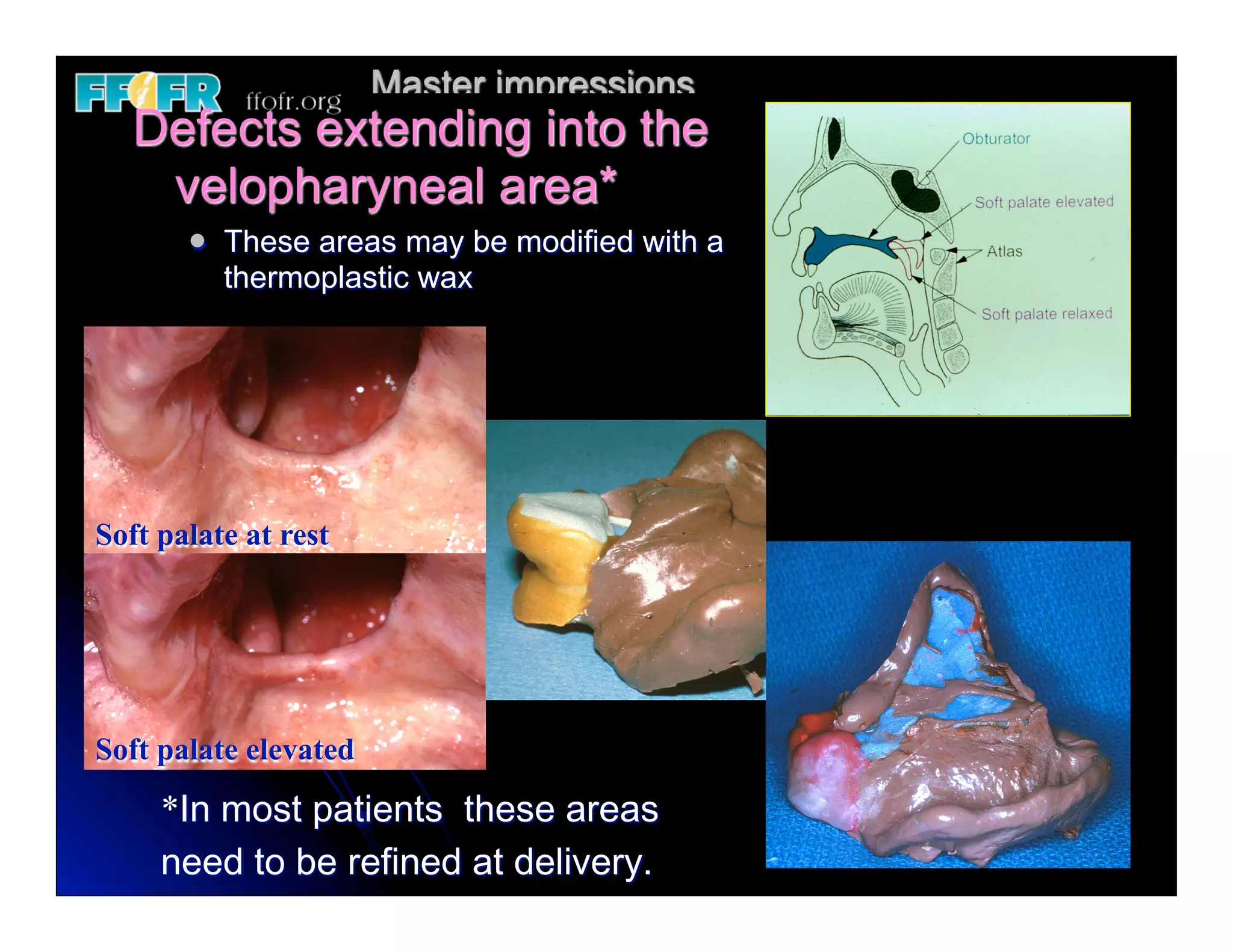 14. (new) definitive obturators edentulous patients | PDF