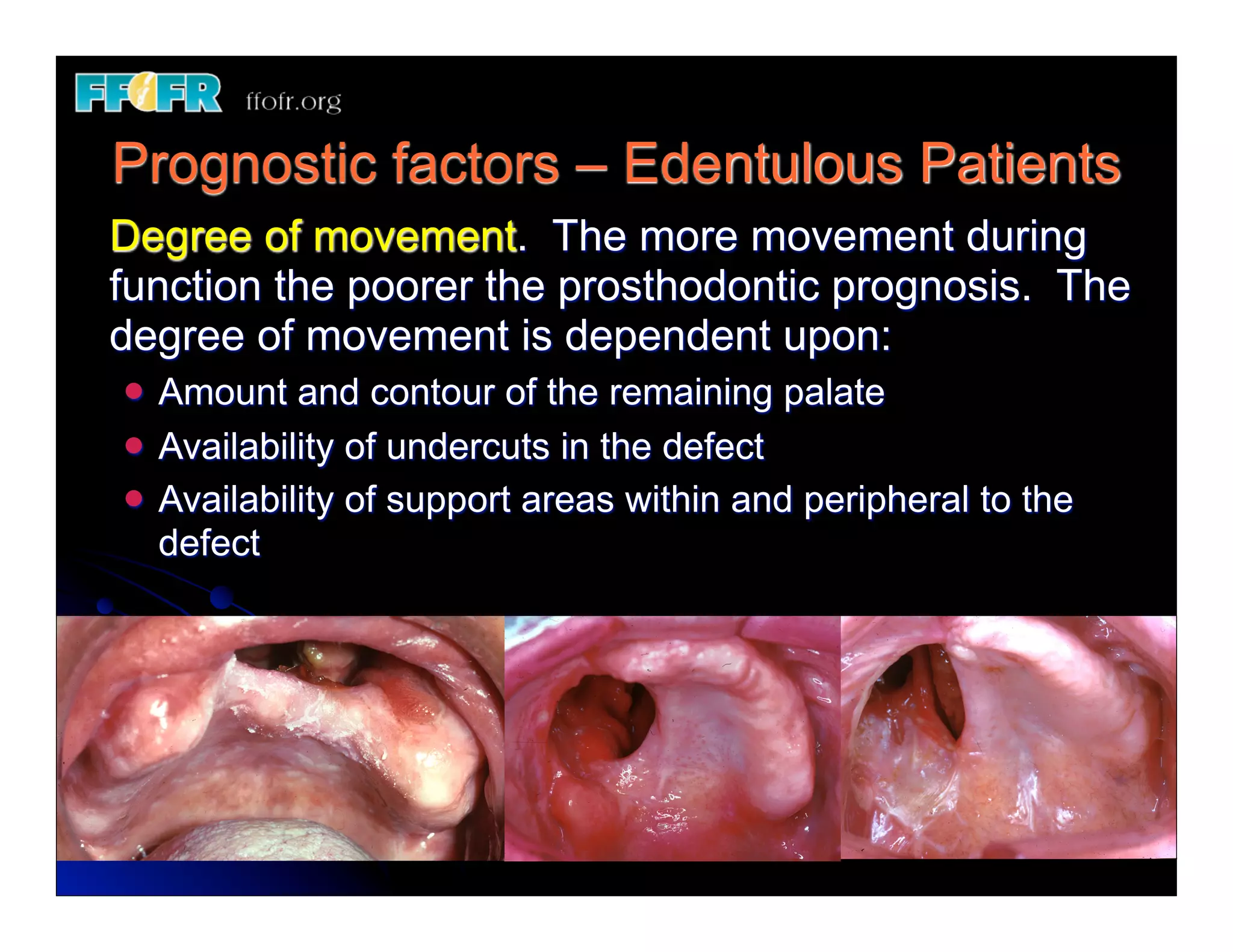 14. (new) definitive obturators edentulous patients | PDF