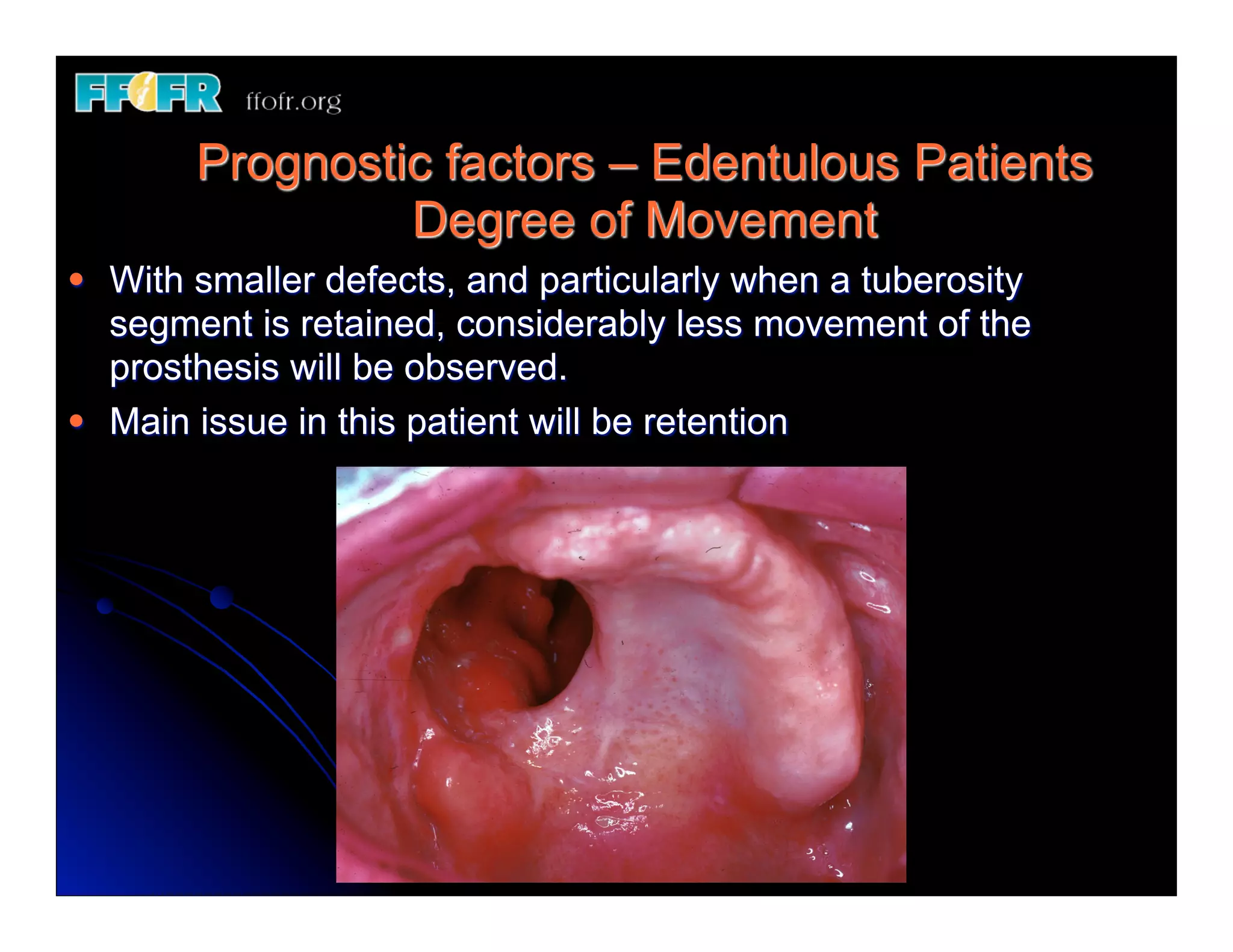 14. (new) definitive obturators edentulous patients | PDF