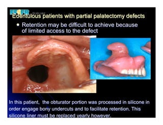 14. (new) definitive obturators edentulous patients | PDF