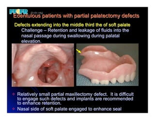 14. (new) definitive obturators edentulous patients | PDF