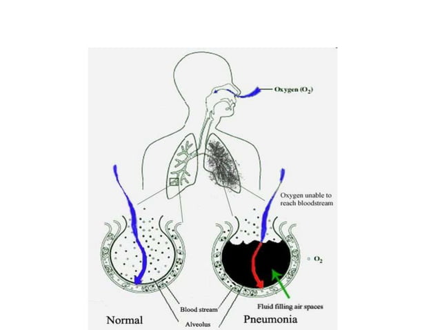 14- Pneumonia medical lecture.pptttttttt | PPT