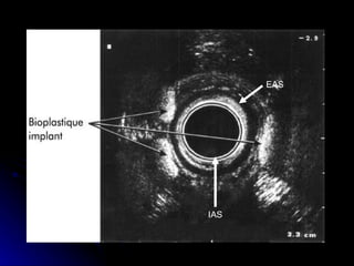 14. Ptq Injections For Faecal Incontinence | PPT