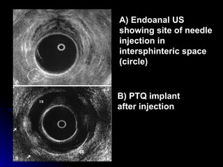 14. Ptq Injections For Faecal Incontinence | PPT | Digestive Disorders ...