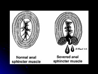 14. Ptq Injections For Faecal Incontinence | PPT