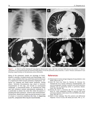 14. westermark's sign | PDF