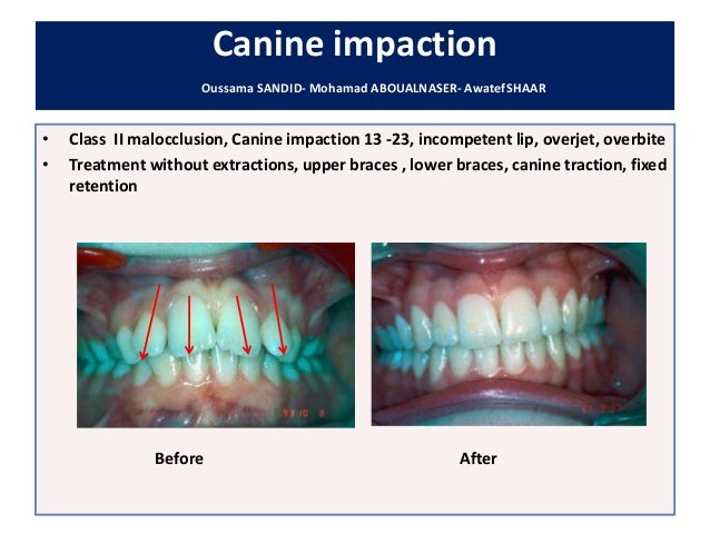 140 canine impaction - canine incluse-orthodontic treatment-case-repo…