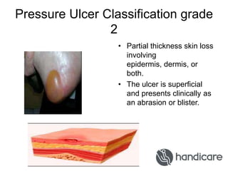 Reducing the incidence of pressure sores and shearing damage for bed ...